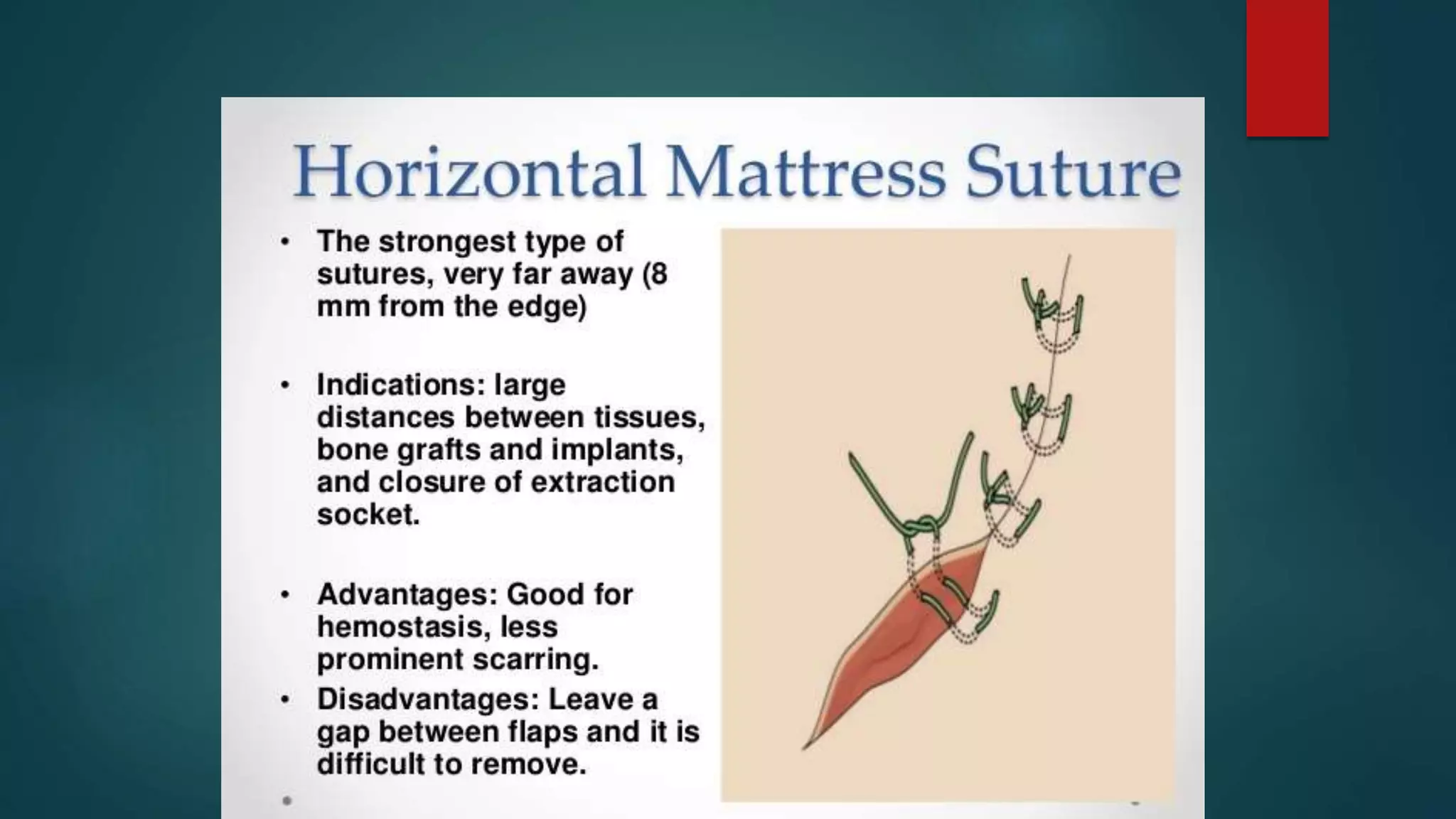 Suture techniques, Z-plasty | PPTX
