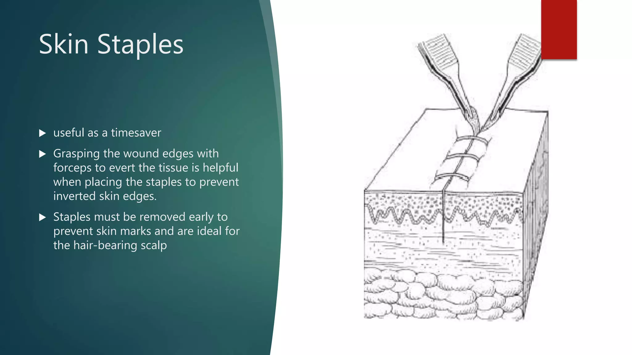 Suture techniques, Z-plasty | PPTX