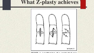 Suture techniques, Z-plasty | PPT