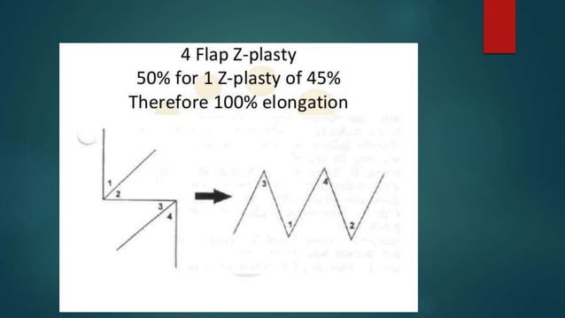 Suture techniques, Z-plasty | PPT