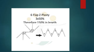 Suture techniques, Z-plasty | PPT