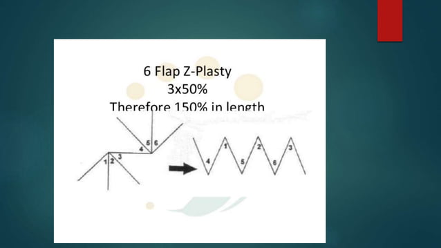Suture techniques, Z-plasty | PPT