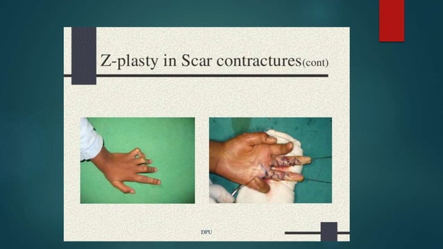 Suture techniques, Z-plasty | PPT