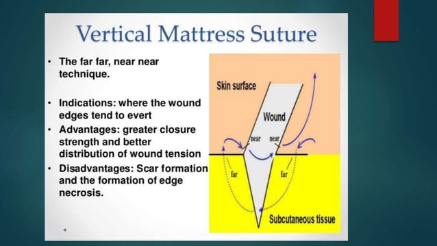Suture techniques, Z-plasty | PPT