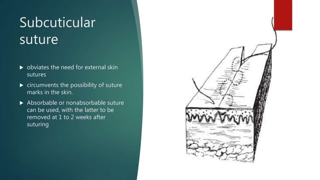 Suture techniques, Z-plasty | PPT