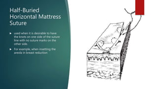 Suture techniques, Z-plasty | PPT