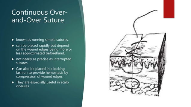 Suture techniques, Z-plasty | PPT