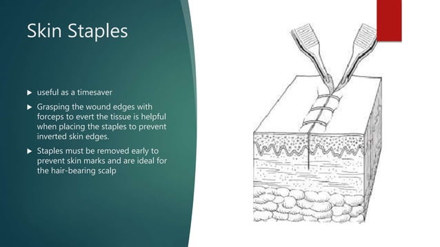 Suture techniques, Z-plasty | PPT