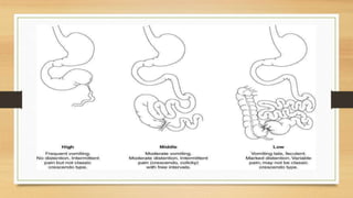 INTESTINAL OBSTRUCTION | PPTX | Digestive Disorders | Diseases and ...