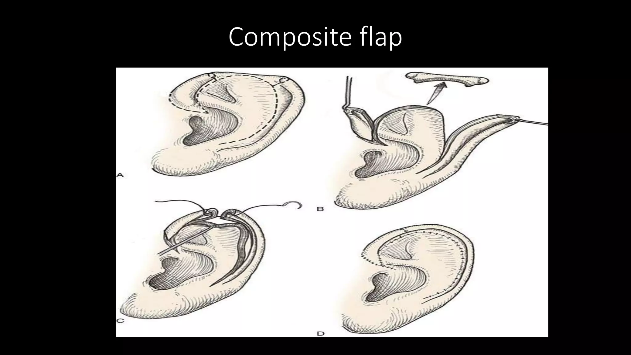 Auricular reconstruction.pptx