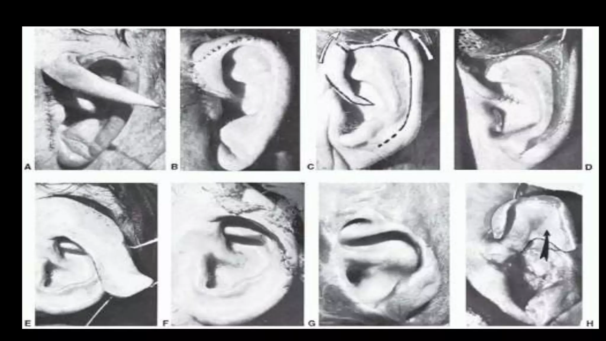 Auricular reconstruction.pptx