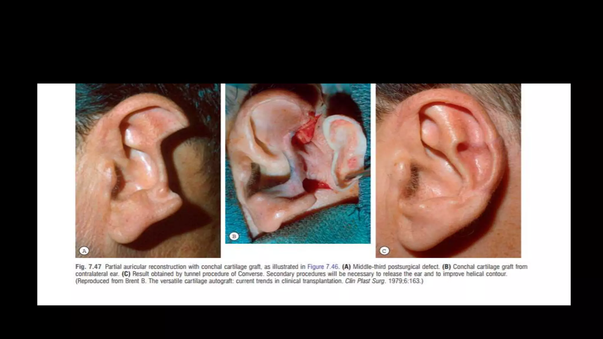 Auricular reconstruction.pptx