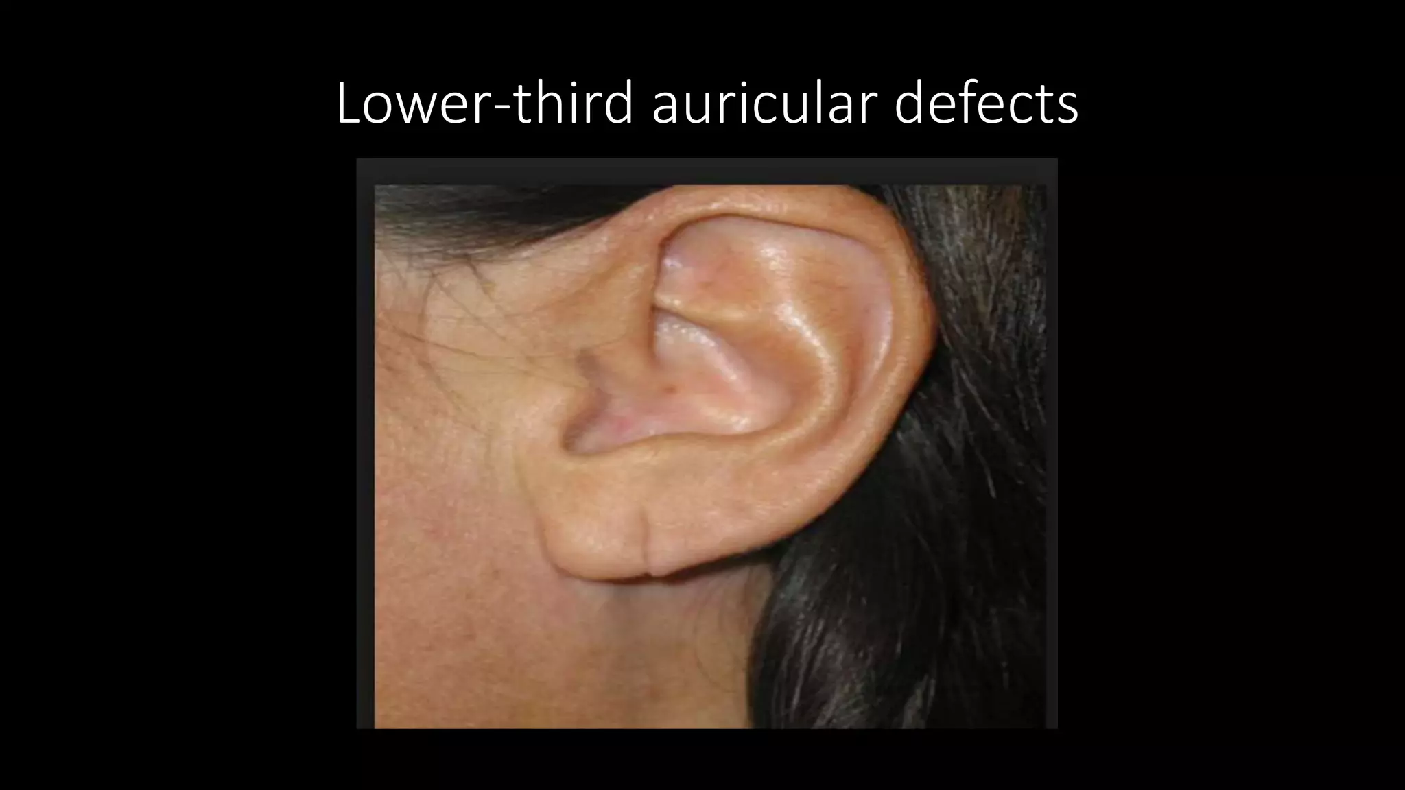 Auricular reconstruction.pptx