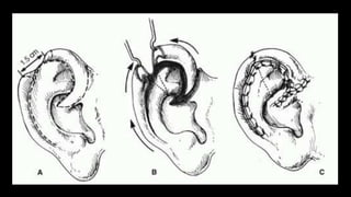 Auricular reconstruction.pptx