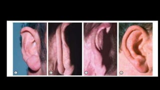 Auricular reconstruction.pptx