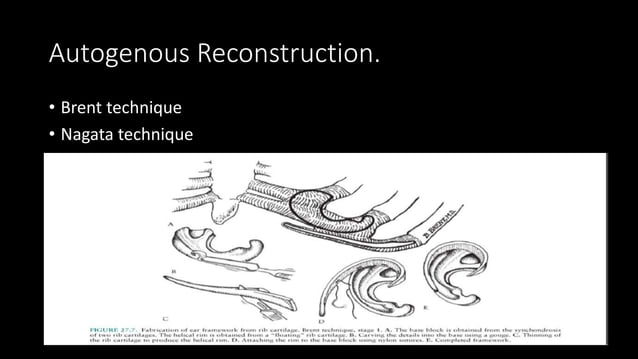 Auricular reconstruction.pptx