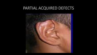 Auricular reconstruction.pptx