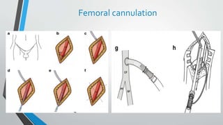 Cannulation for ECMO | PPTX