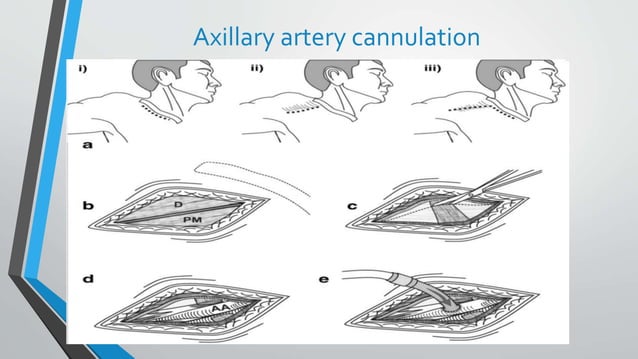 Cannulation for ECMO | PPTX