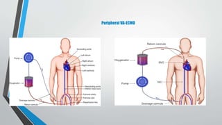 Cannulation for ECMO | PPTX