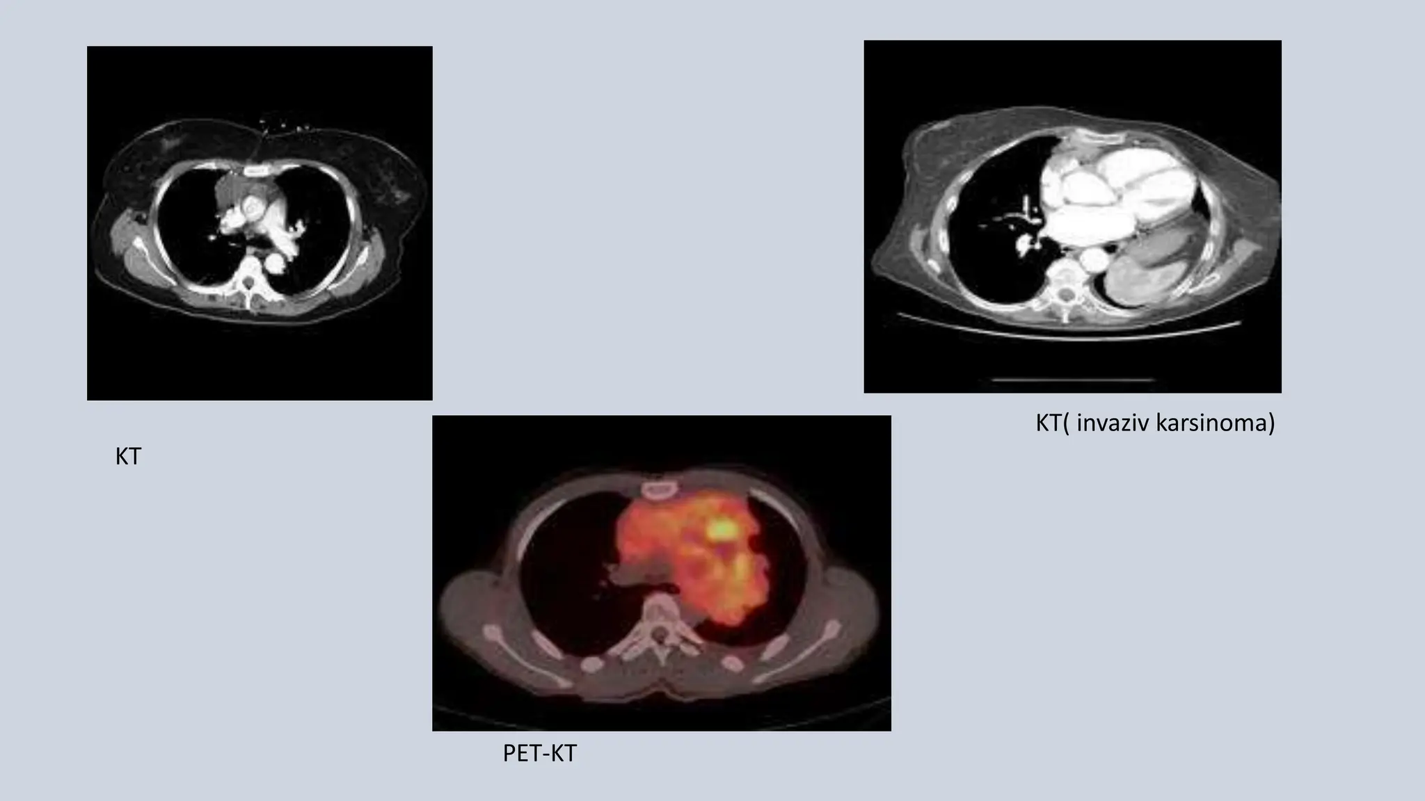 Radiologiya timus şişlərinin radiologiyası, X-ray. | PPTX