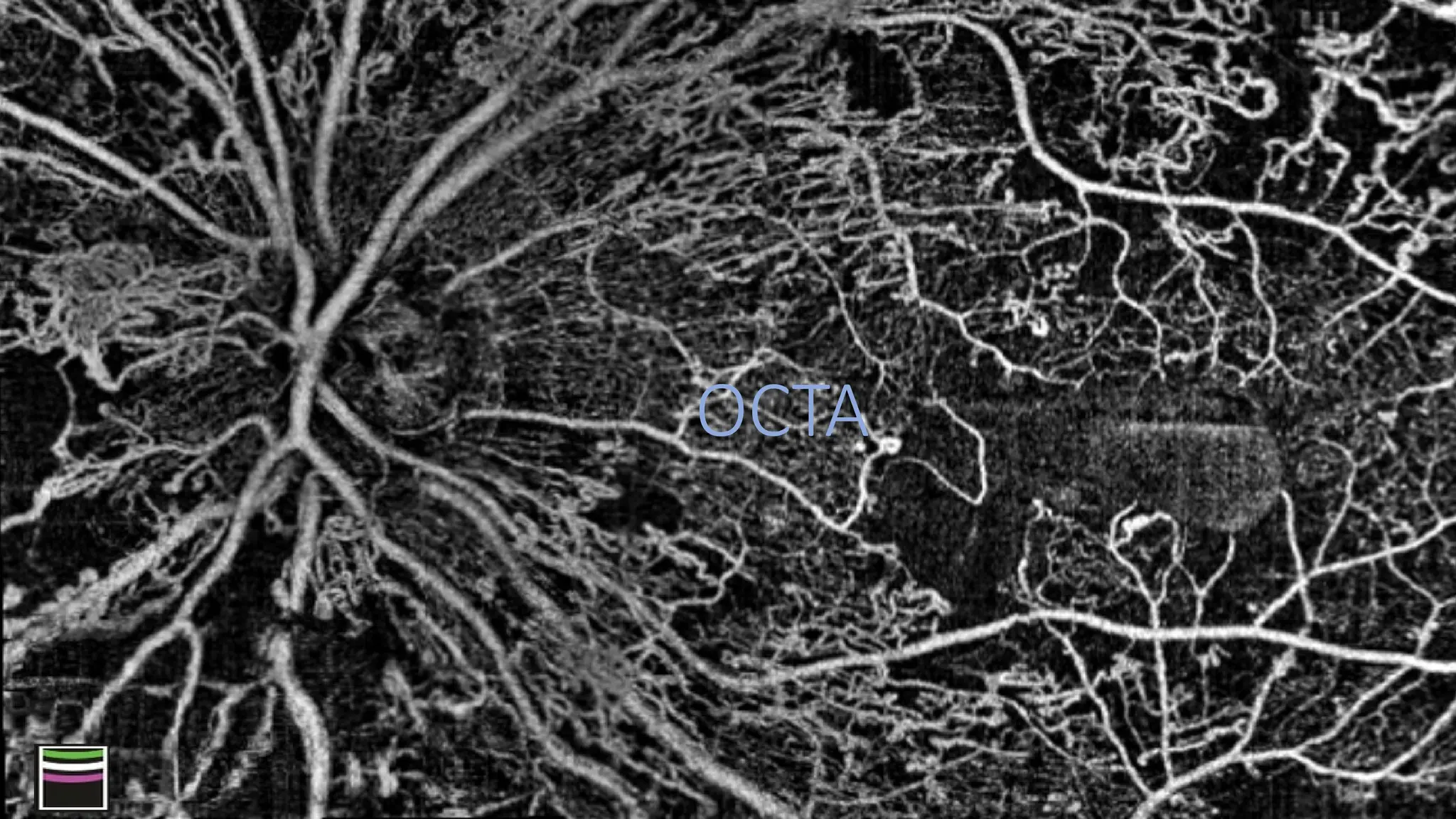 OCT angiography clinical relevance .pptx