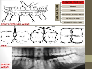 MANAGEMENT OF MAXILLOFACIAL FRACTURES | PPTX