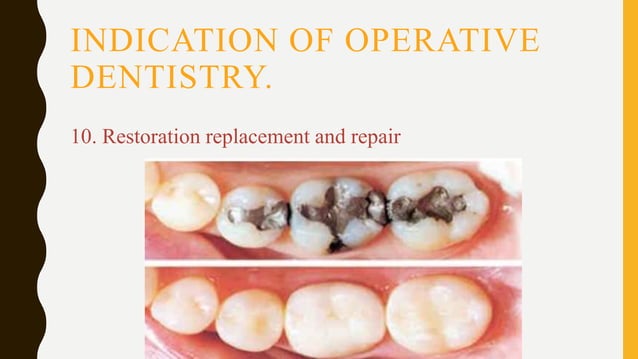 Introduction to Operative Dentistry | PPTX | Dental Health | Diseases ...