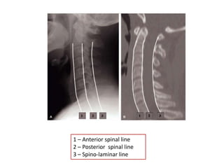 radiological signs of in orthopaedics | PPTX