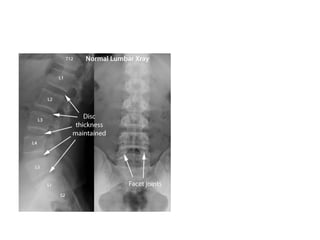 radiological signs of in orthopaedics | PPTX