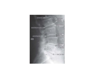 radiological signs of in orthopaedics | PPTX