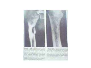 radiological signs of in orthopaedics | PPTX