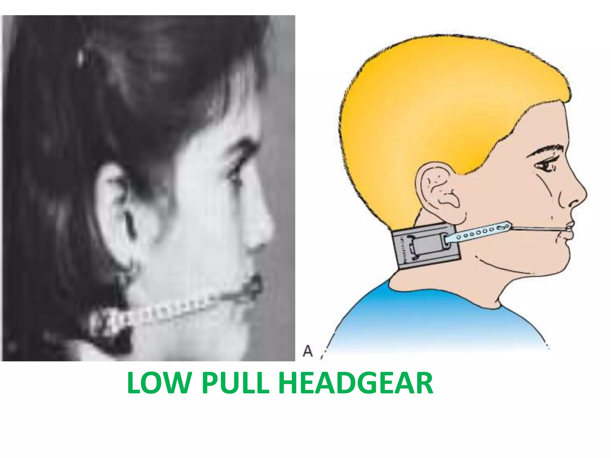 headgear.... | PPTX