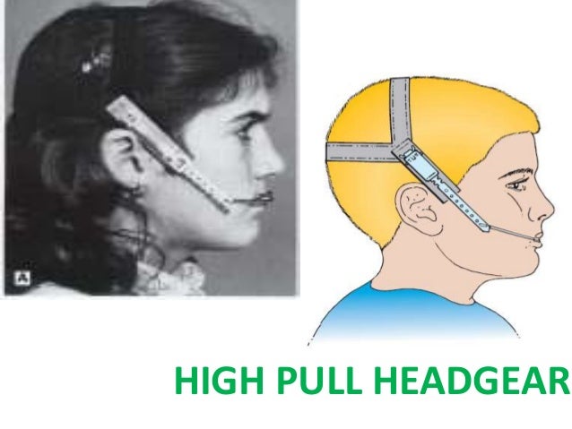 Headgear Orthodontics Slideshare