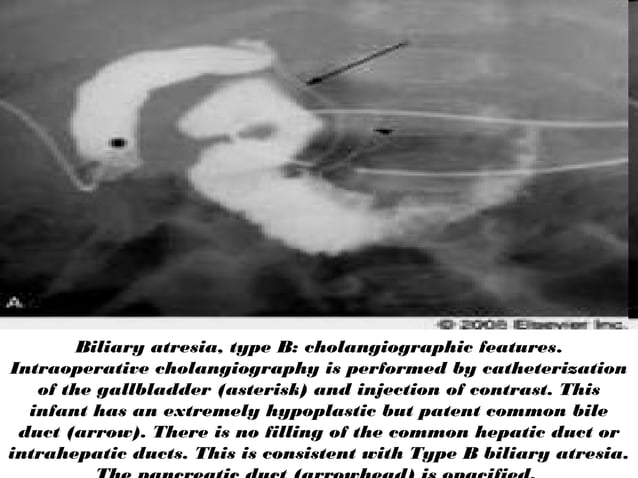 biliary atresia | PPT