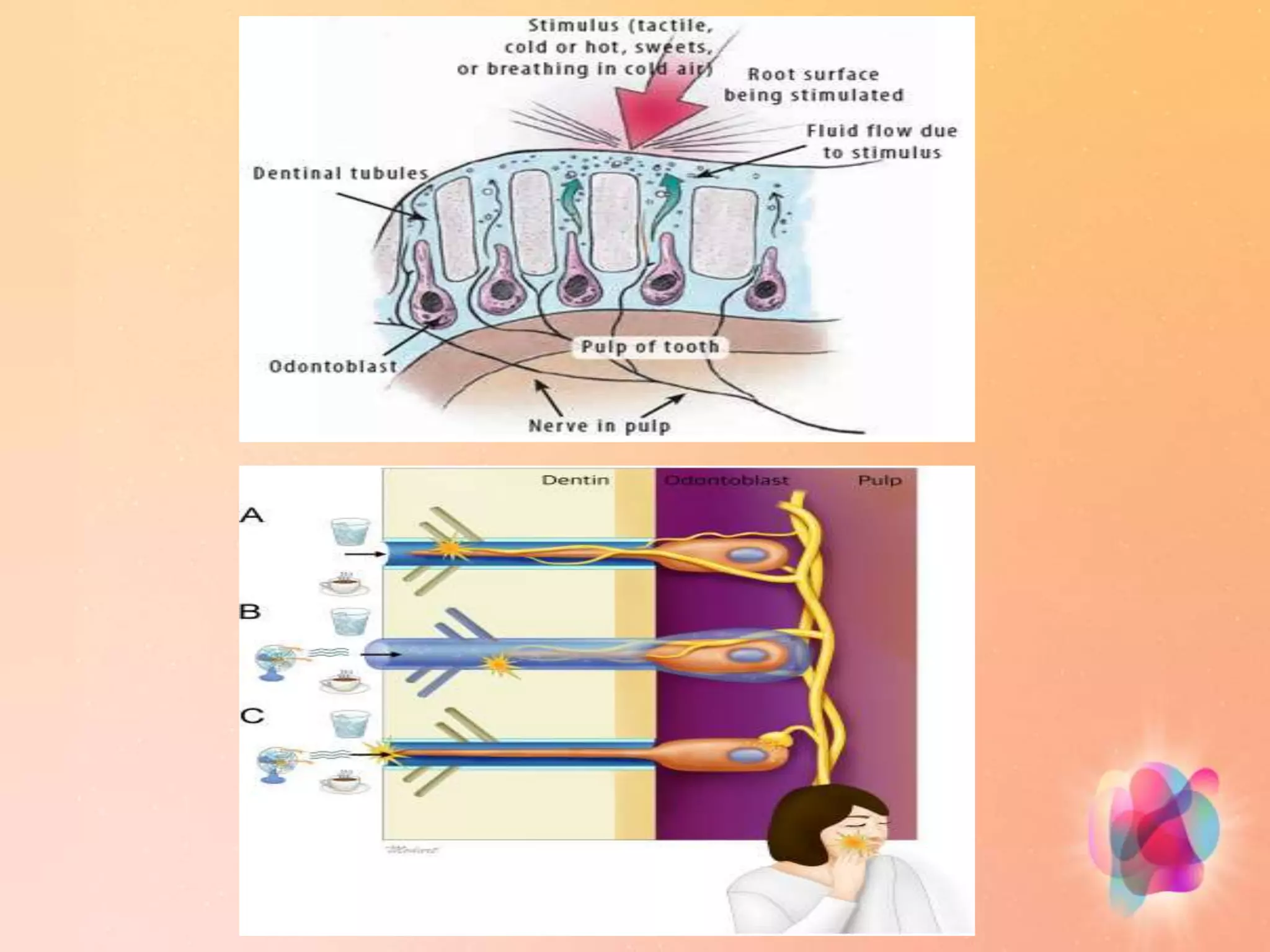 hypersensitivity of teeth and its management | PPTX