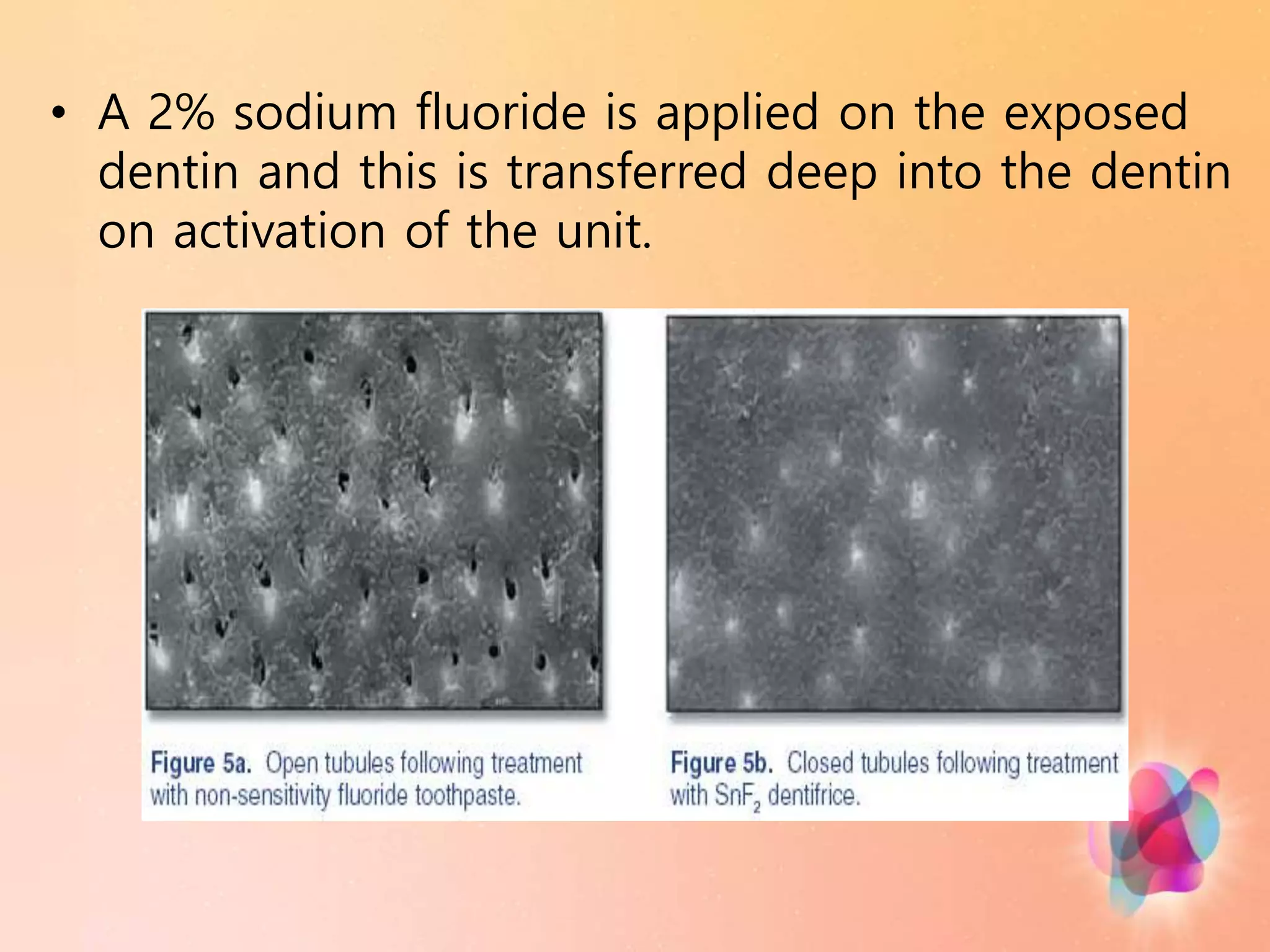 hypersensitivity of teeth and its management | PPTX