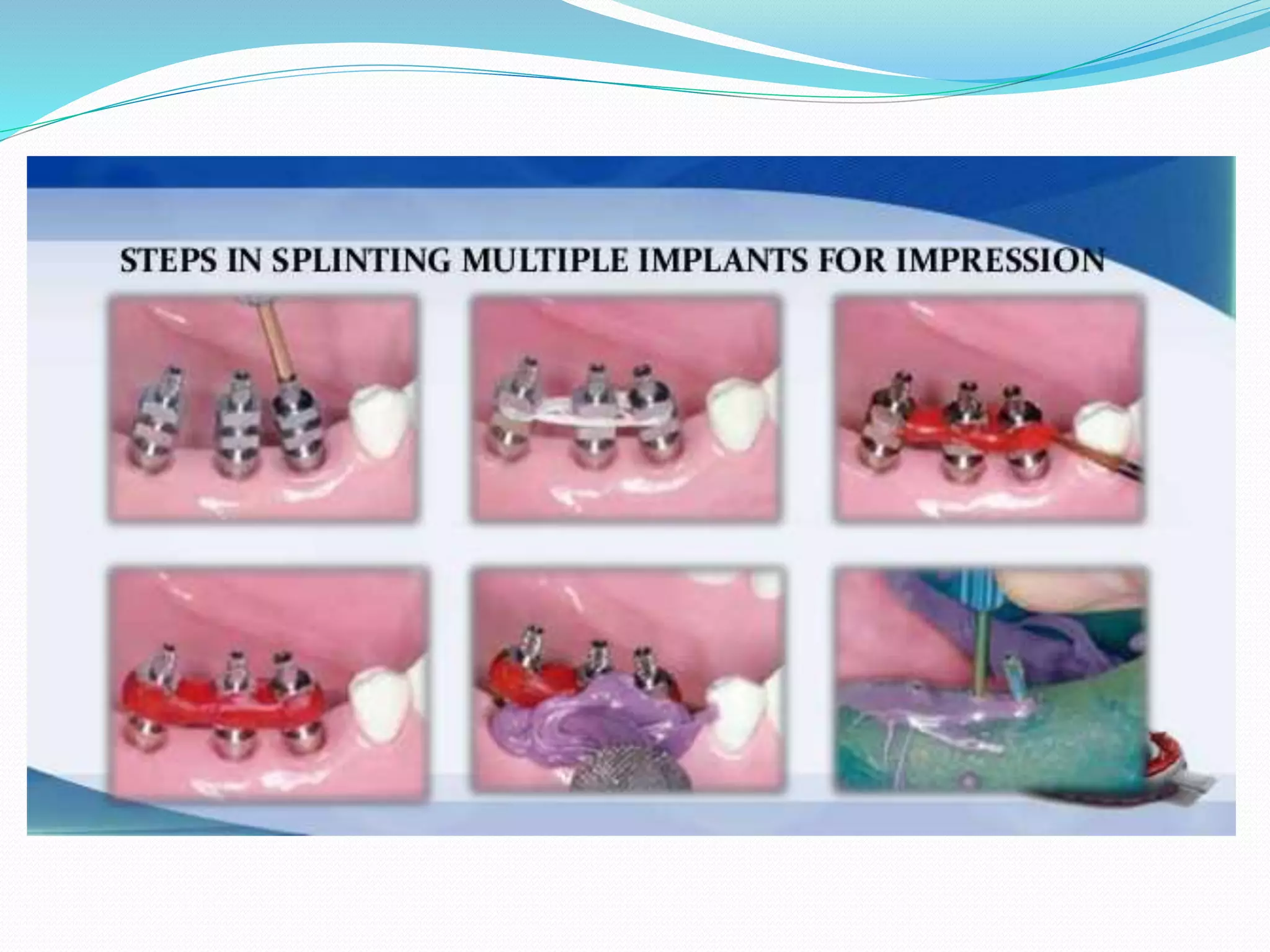 dental implant impression technique | PPTX