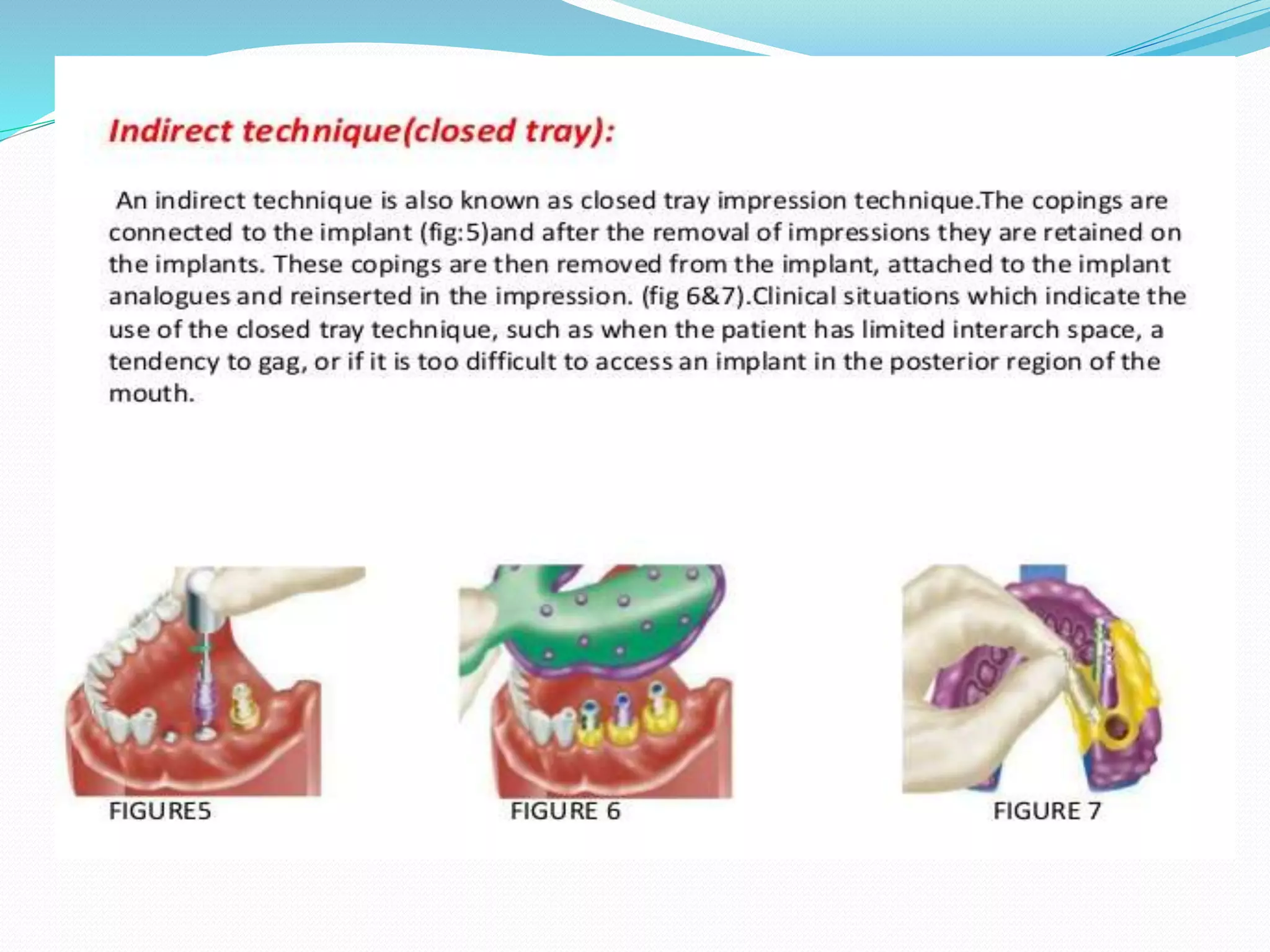 dental implant impression technique | PPTX