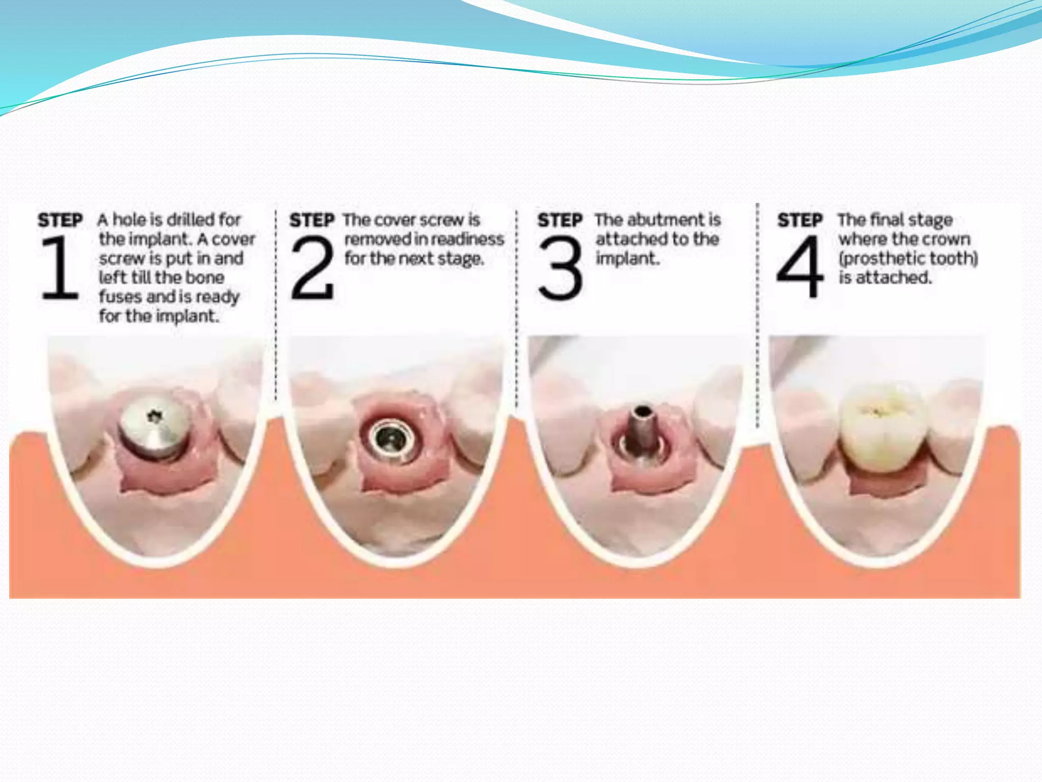 dental implant impression technique | PPTX