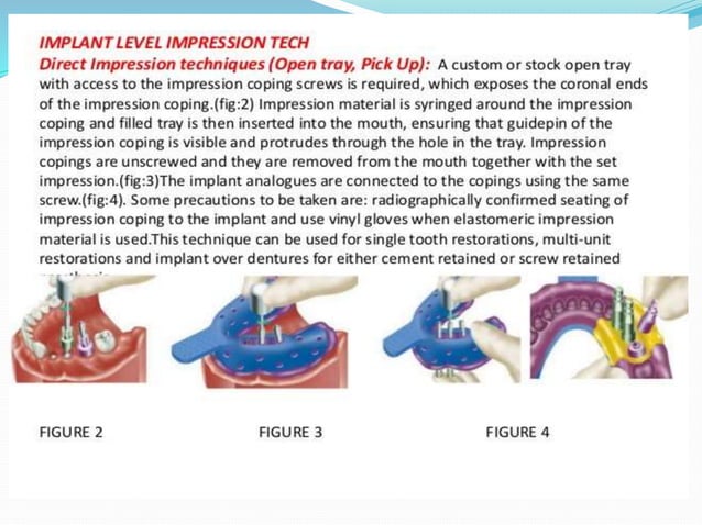 dental implant impression technique | PPTX | Dental Health | Diseases ...