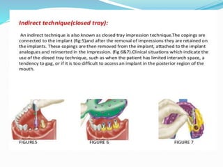 dental implant impression technique | PPTX
