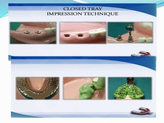 dental implant impression technique | PPTX