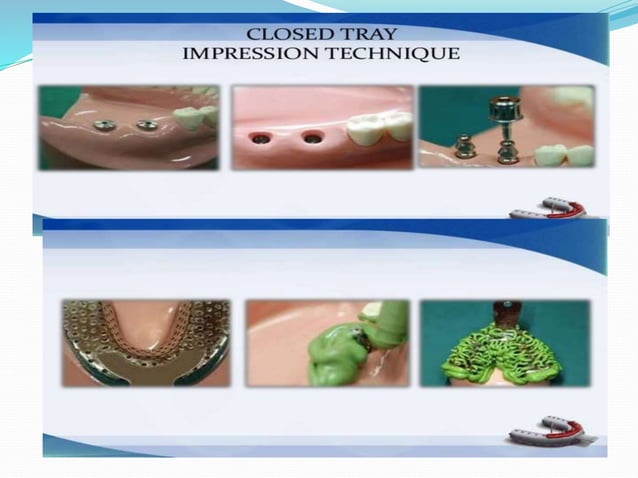 dental implant impression technique | PPTX | Dental Health | Diseases ...
