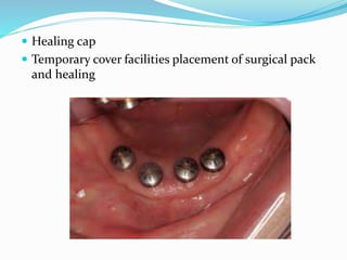 dental implant impression technique | PPTX