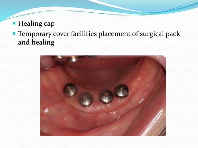 dental implant impression technique | PPTX | Dental Health | Diseases ...
