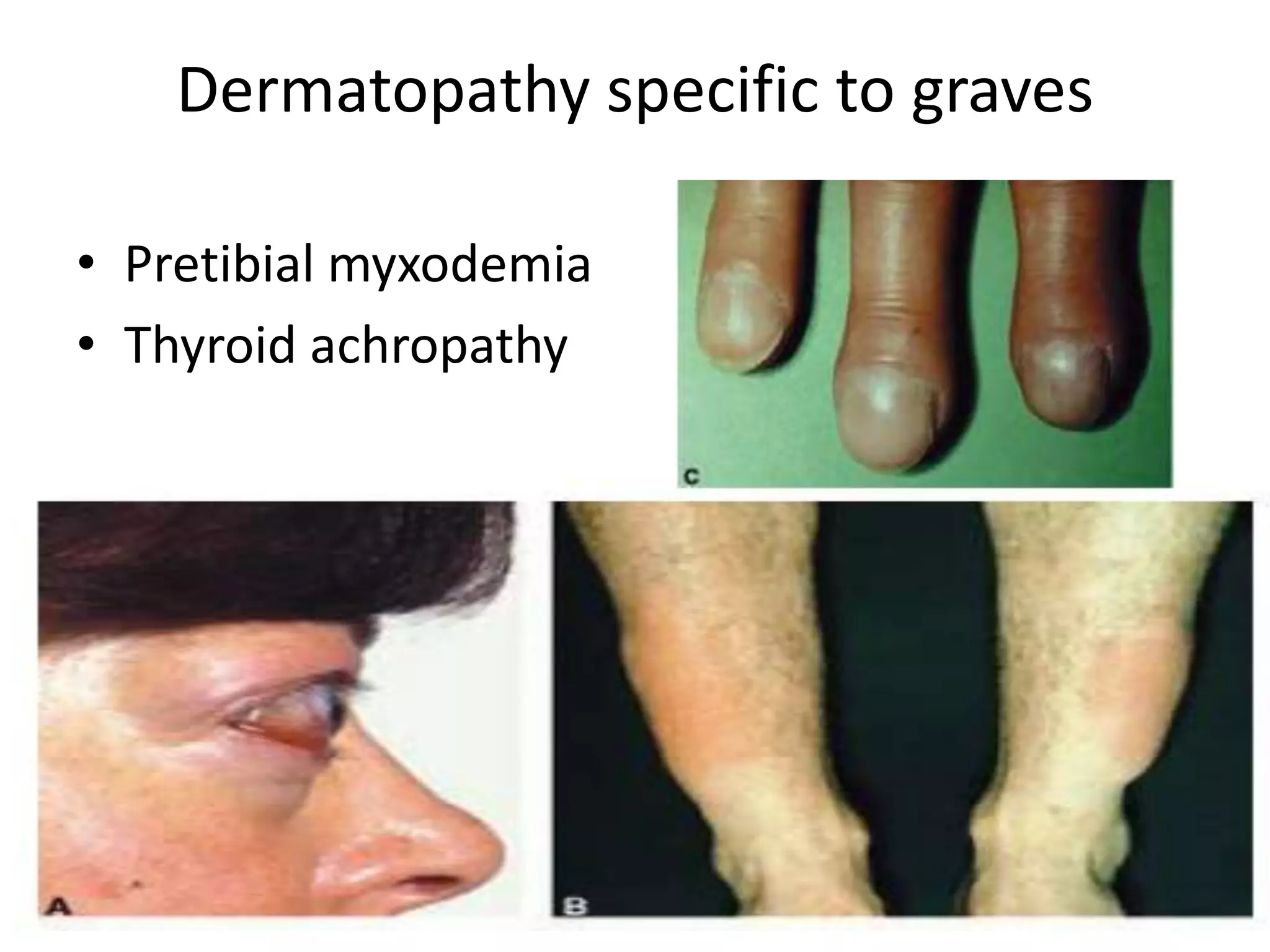 Graves disease and Thyroid eye disease with orbital decompression | PPT