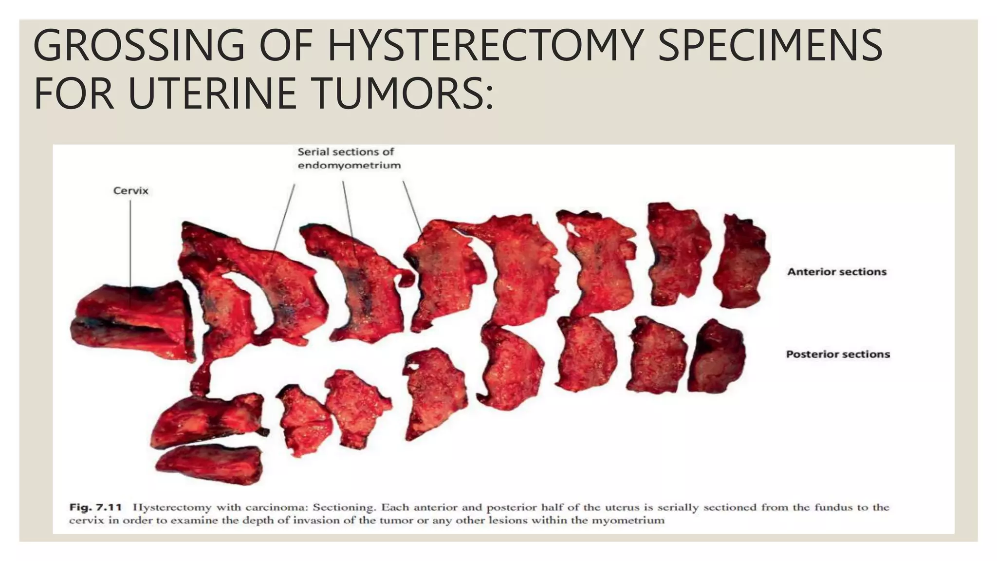 Grossing of hysterectomy specimens | PPTX