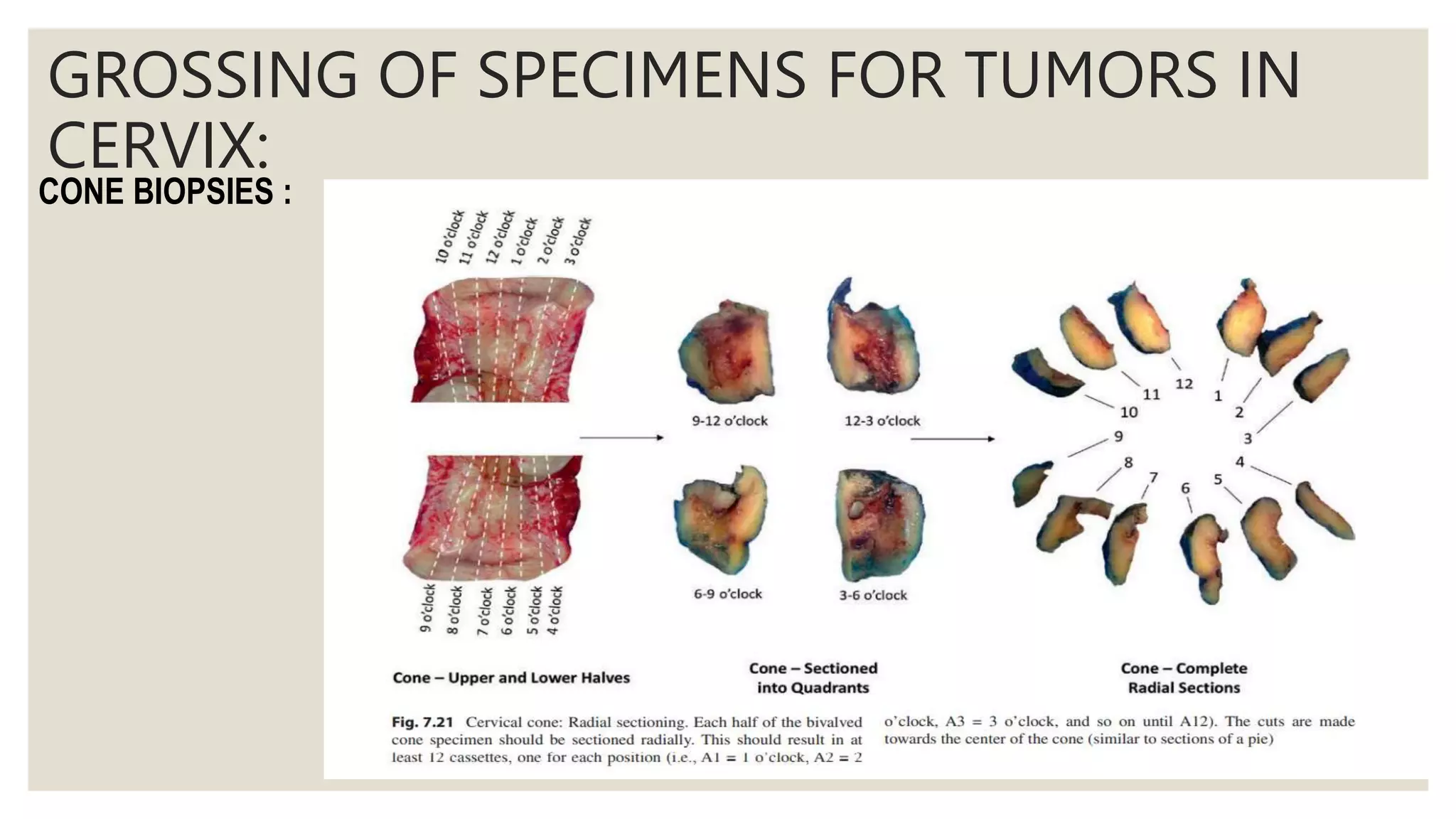 Grossing of hysterectomy specimens | PPTX