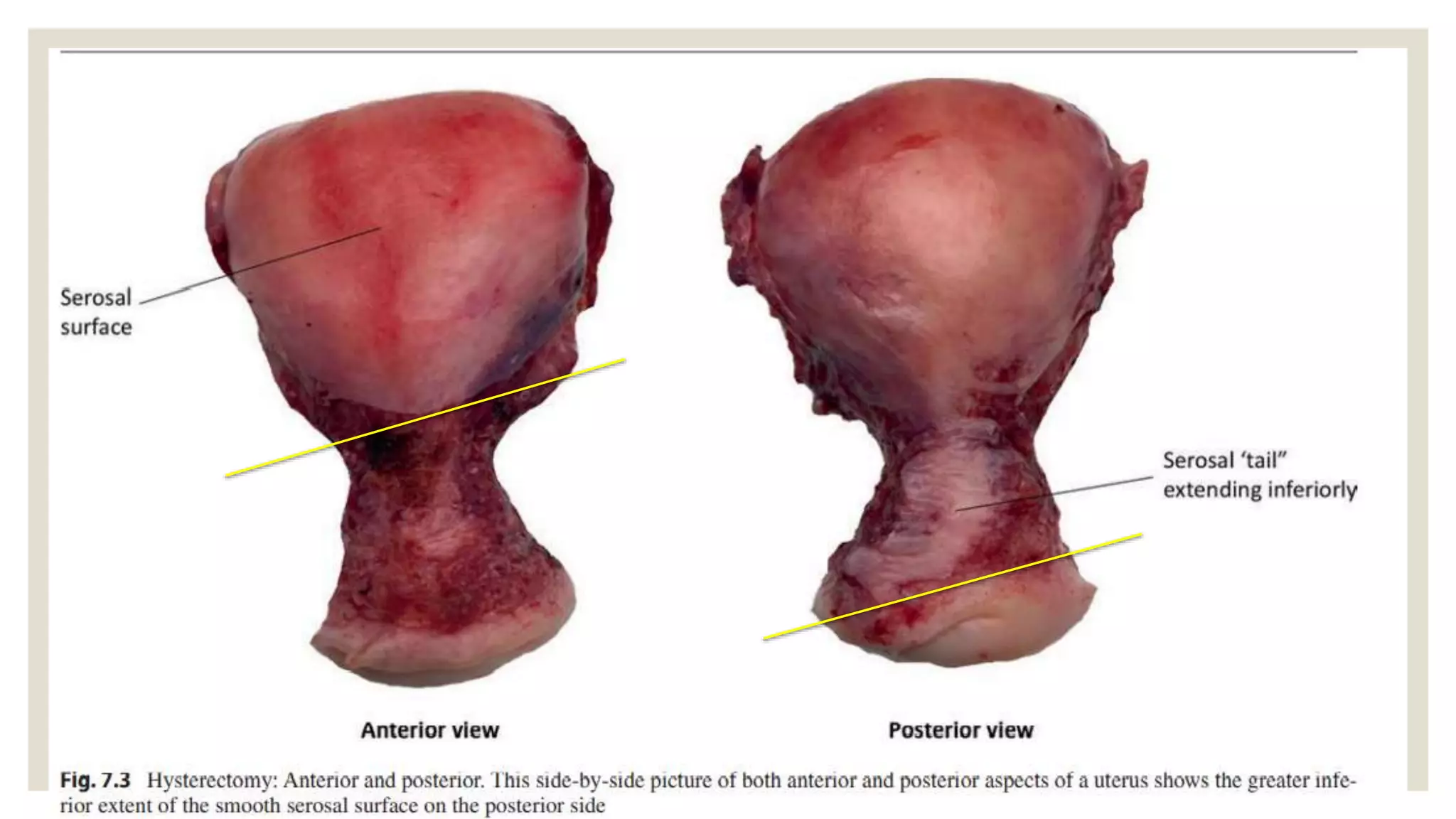 Grossing of hysterectomy specimens | PPTX